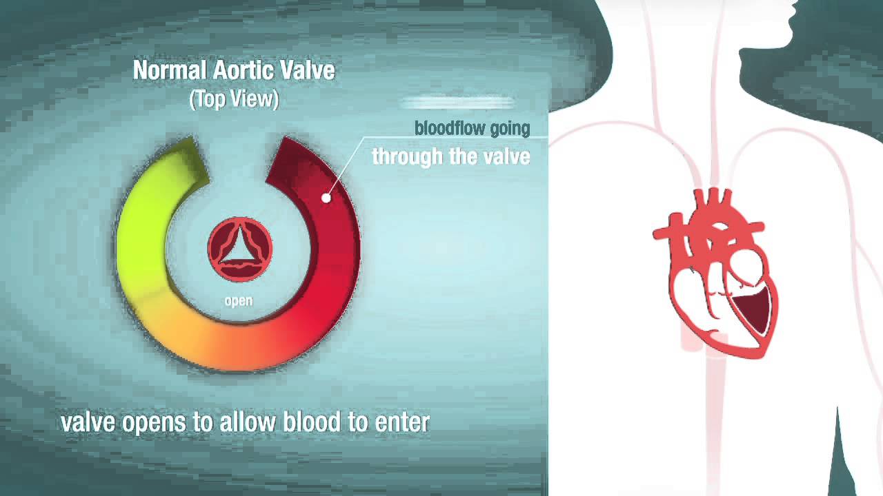 Problem: Pulmonary Valve Stenosis | American Heart Association Problem: Pulmonary Valve Stenosis | American Heart Association