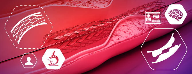 Stent retrievers revolutionize treatment for severe strokes | American ...