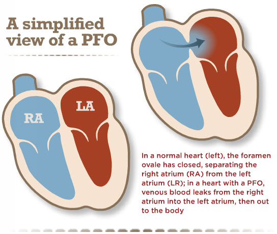 Patent Foramen Ovale (PFO) | American Heart Association