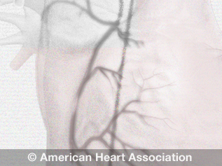 Coronary Angiogram | American Heart Association