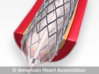 What is a Stent? | American Heart Association