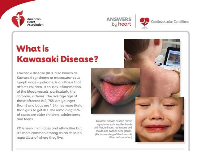Kawasaki Disease Resurgence Of Kawasaki Disease Following Relaxation