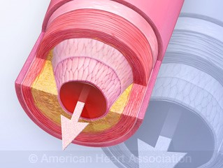 Peripheral Angiography | American Heart Association