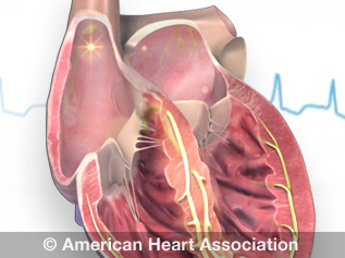 What is Atrial Flutter? | American Heart Association