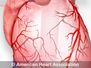 Coronary Microvascular Disease (MVD) | American Heart Association