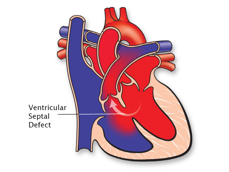 Common heart defect could limit exercise ability that worsens with age ...