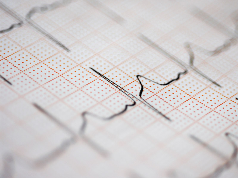 Smartphone-based tool helps detect irregular heartbeat in American ...