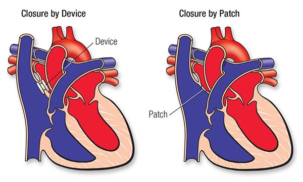 Atrial Septal Defect Asd American Heart Association