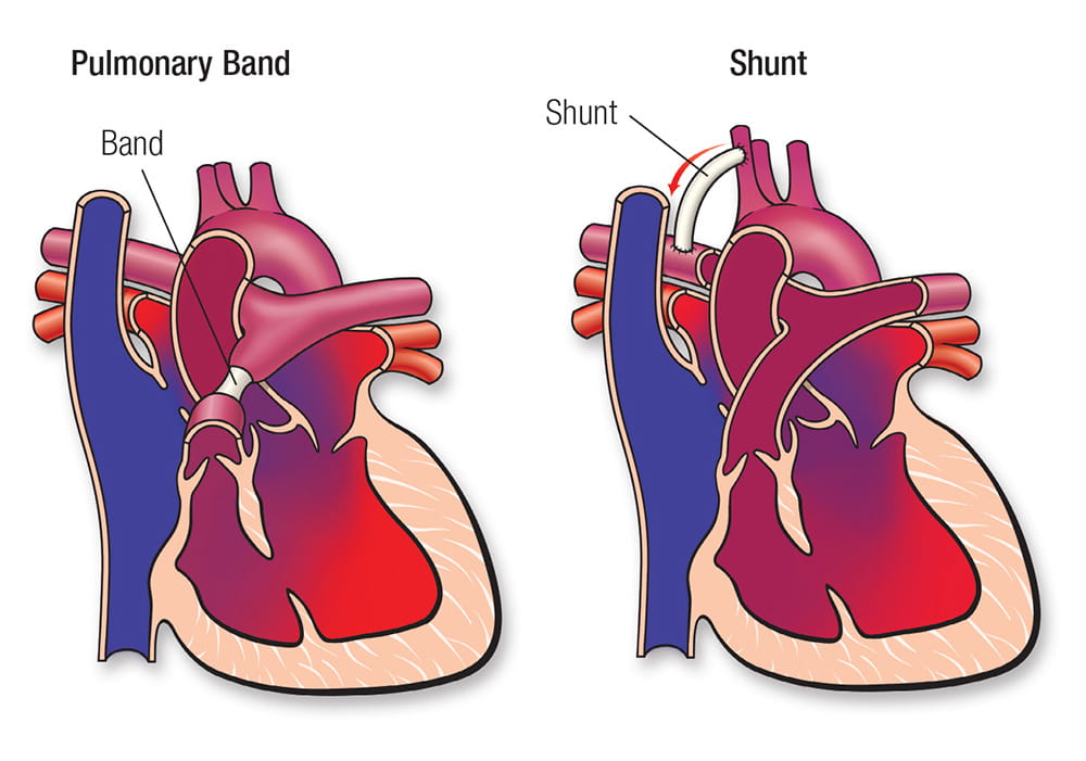 Single Ventricle Defects | American Heart Association