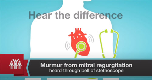 Heart Murmurs | American Heart Association