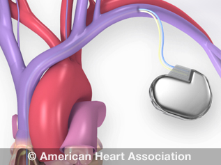 Pacemaker | American Heart Association