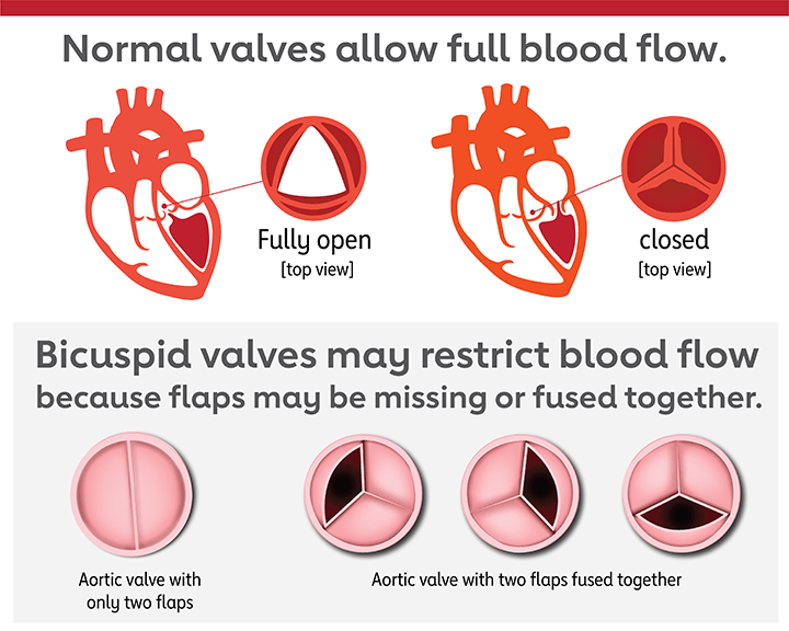 Roles of Your Four Heart Valves | American Heart Association