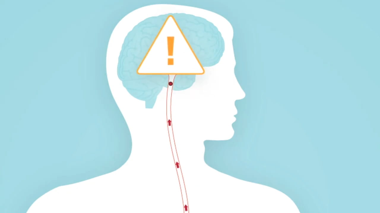 Study of skiers holds surprises about AFib, stroke and intense exercise ...