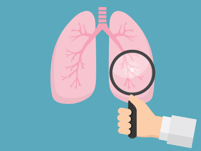 Pulmonary embolism is common and can be deadly, but few know the signs ...